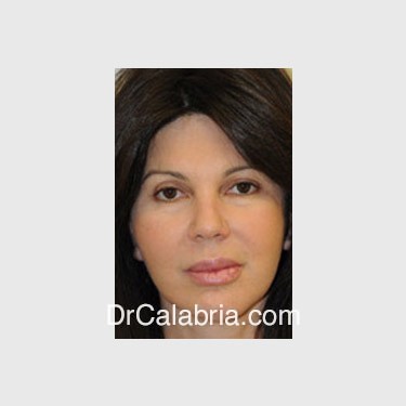 Before and After One Stitch Facelift Patient 2 Gallery | Renato ...