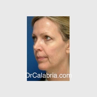 One Stitch Facelift Photo Gallery - Palm Springs, CA | Renato Calabria ...