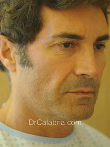 Male Facelift - Palm Springs, CA | Renato Calabria MD FACS