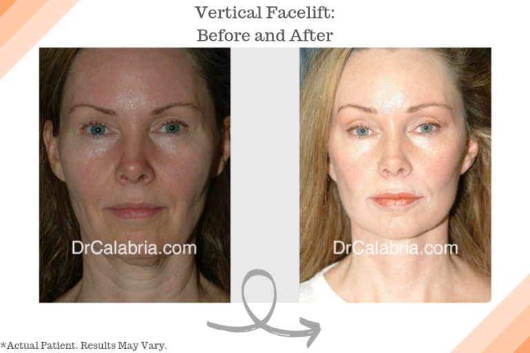 Achieve Natural Results With the Vertical Facelift | Renato Calabria MD ...